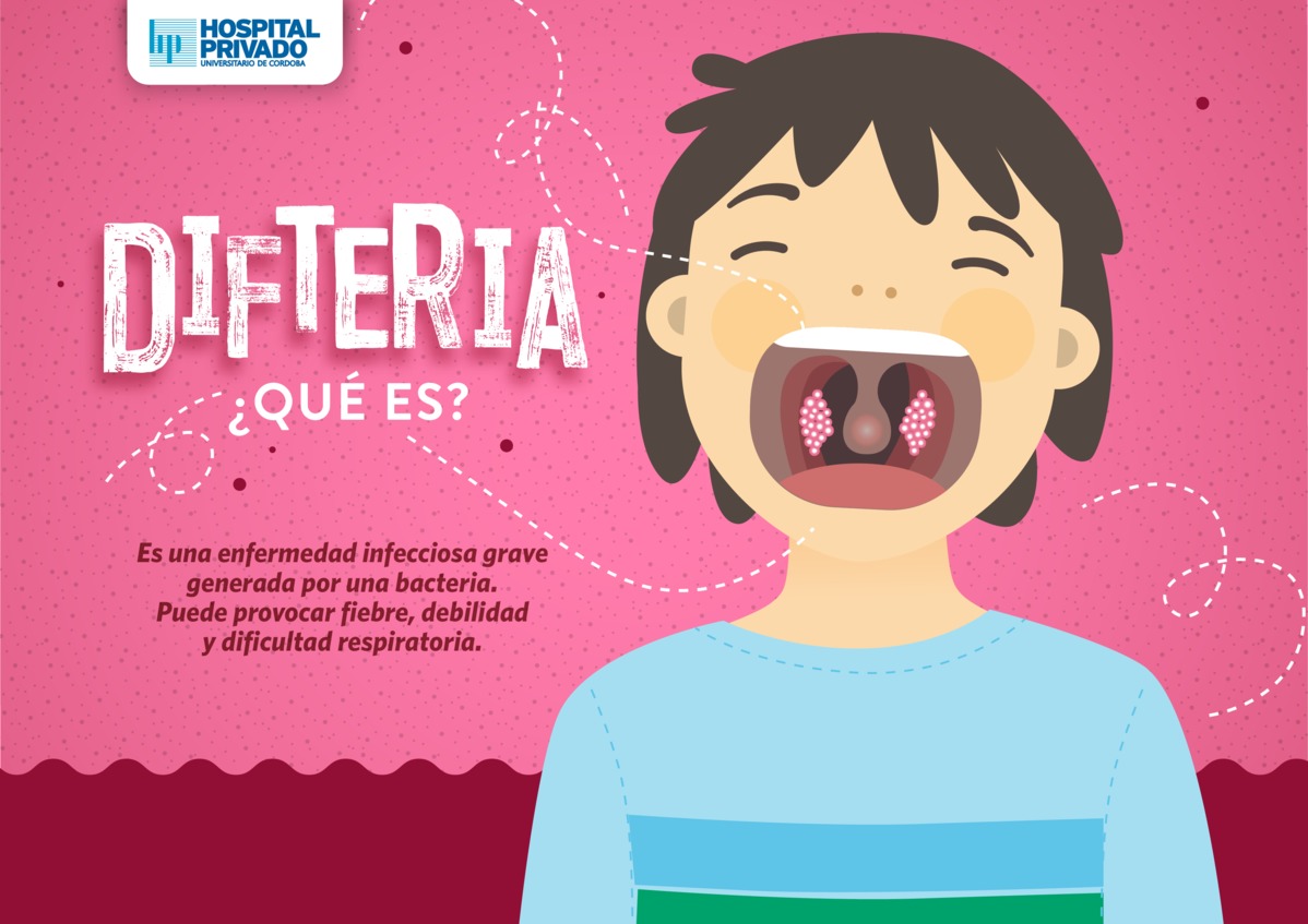 Difteria: Causas, Síntomas, Tratamiento y Prevención | Guía de salud ...